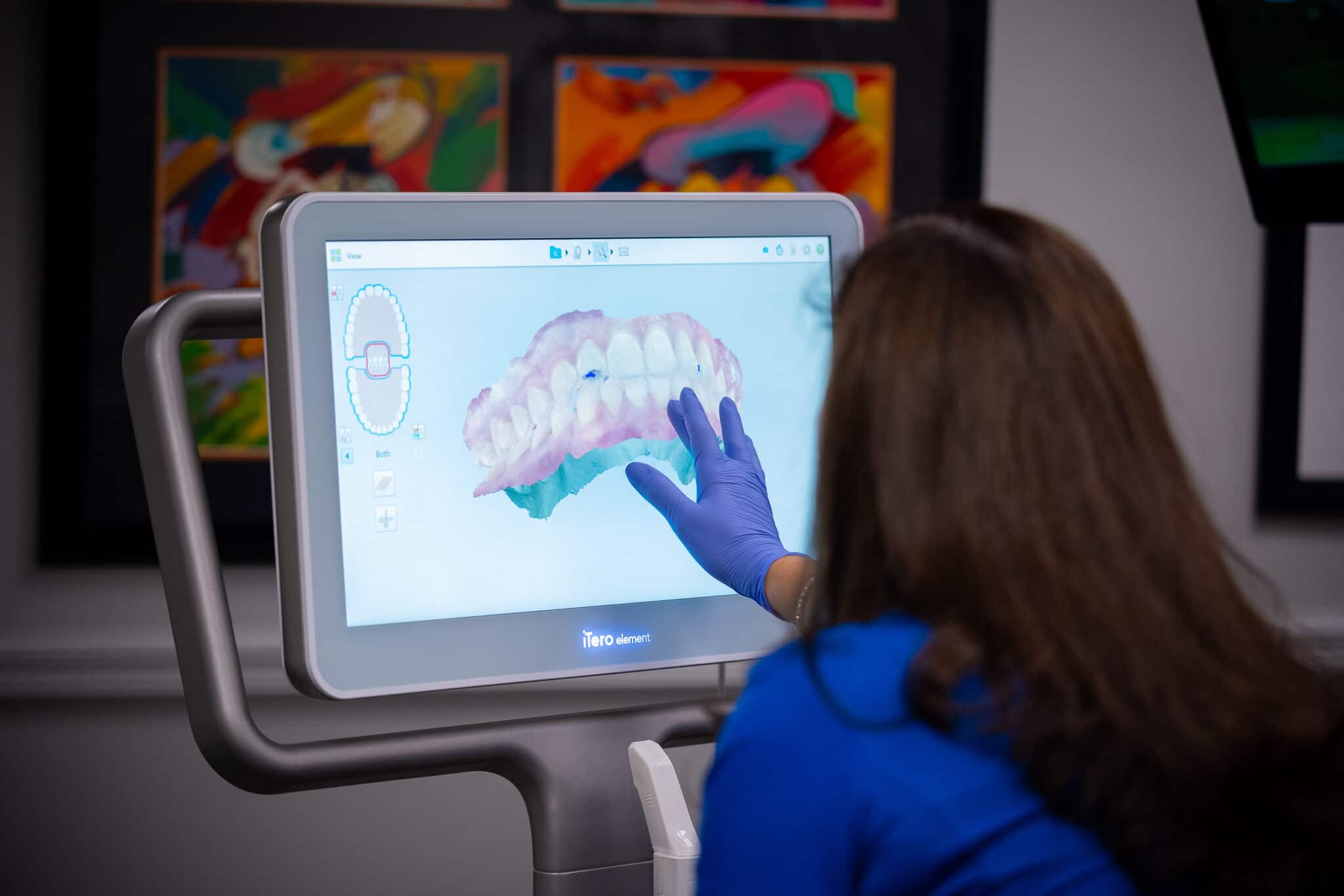 LightForce 3D Printed Braces - Zombek Orthodontics - Hollywood, FL