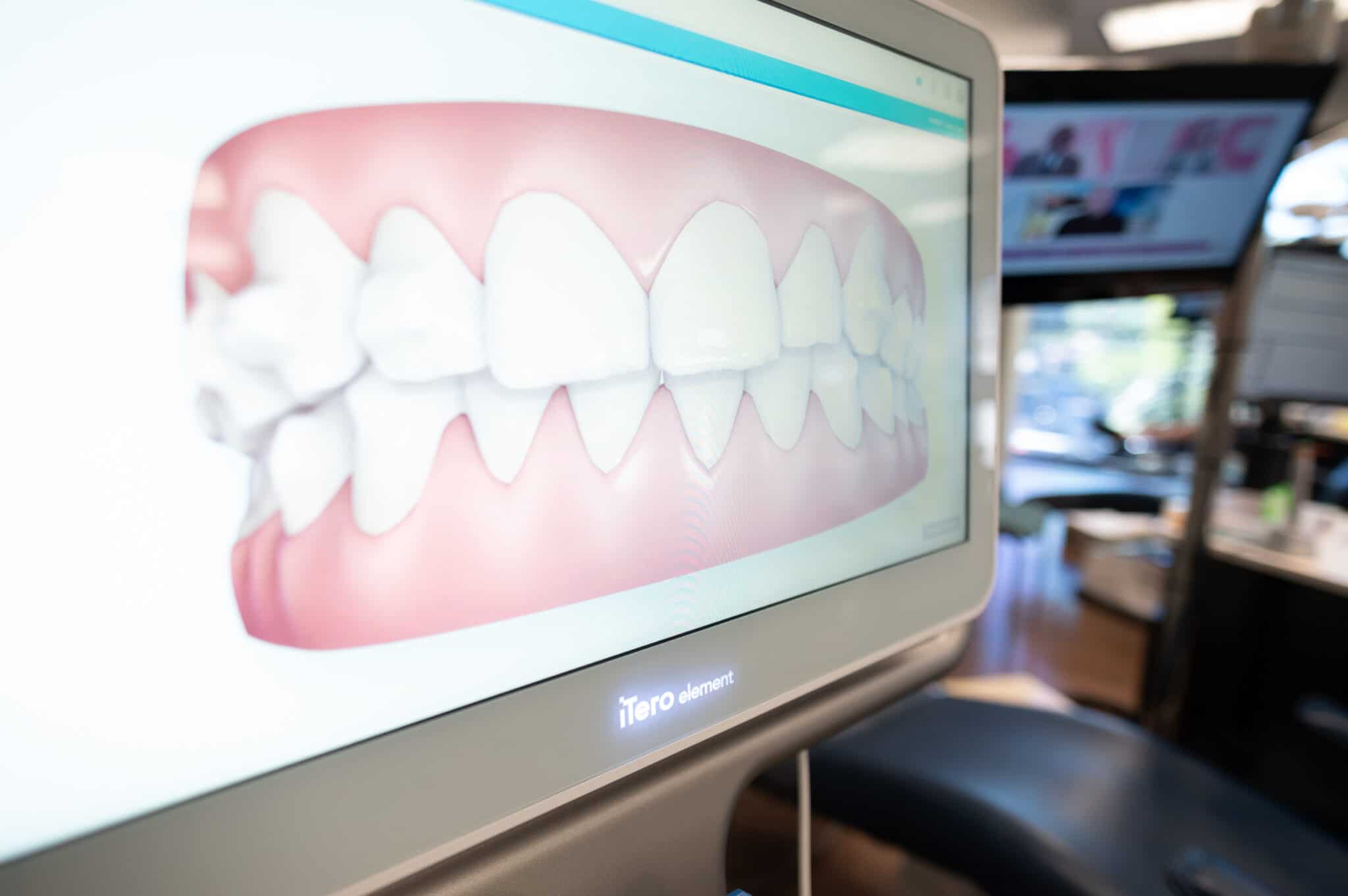 LightForce 3D Printed Braces - Zombek Orthodontics - Hollywood, FL