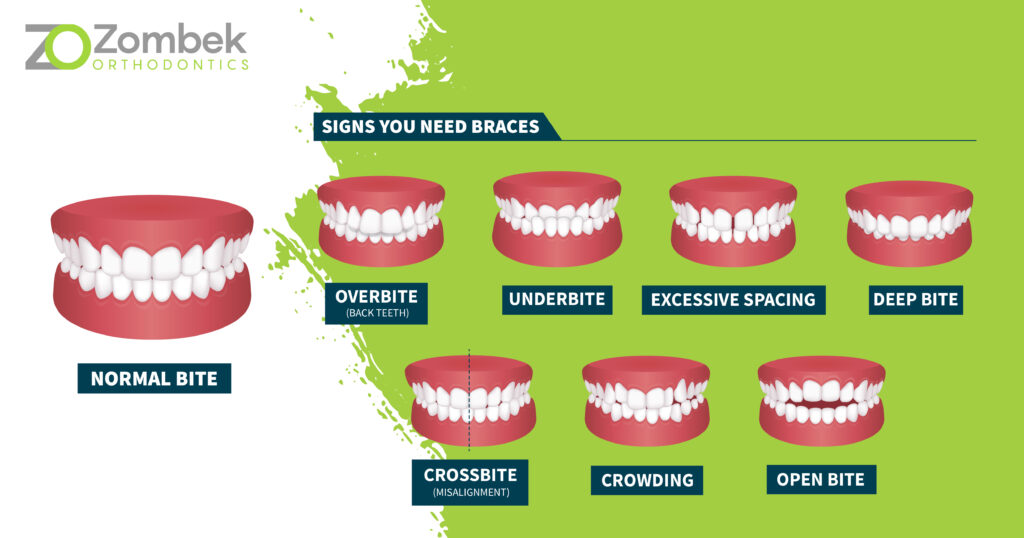 Do I Need Braces? Find Out Today!