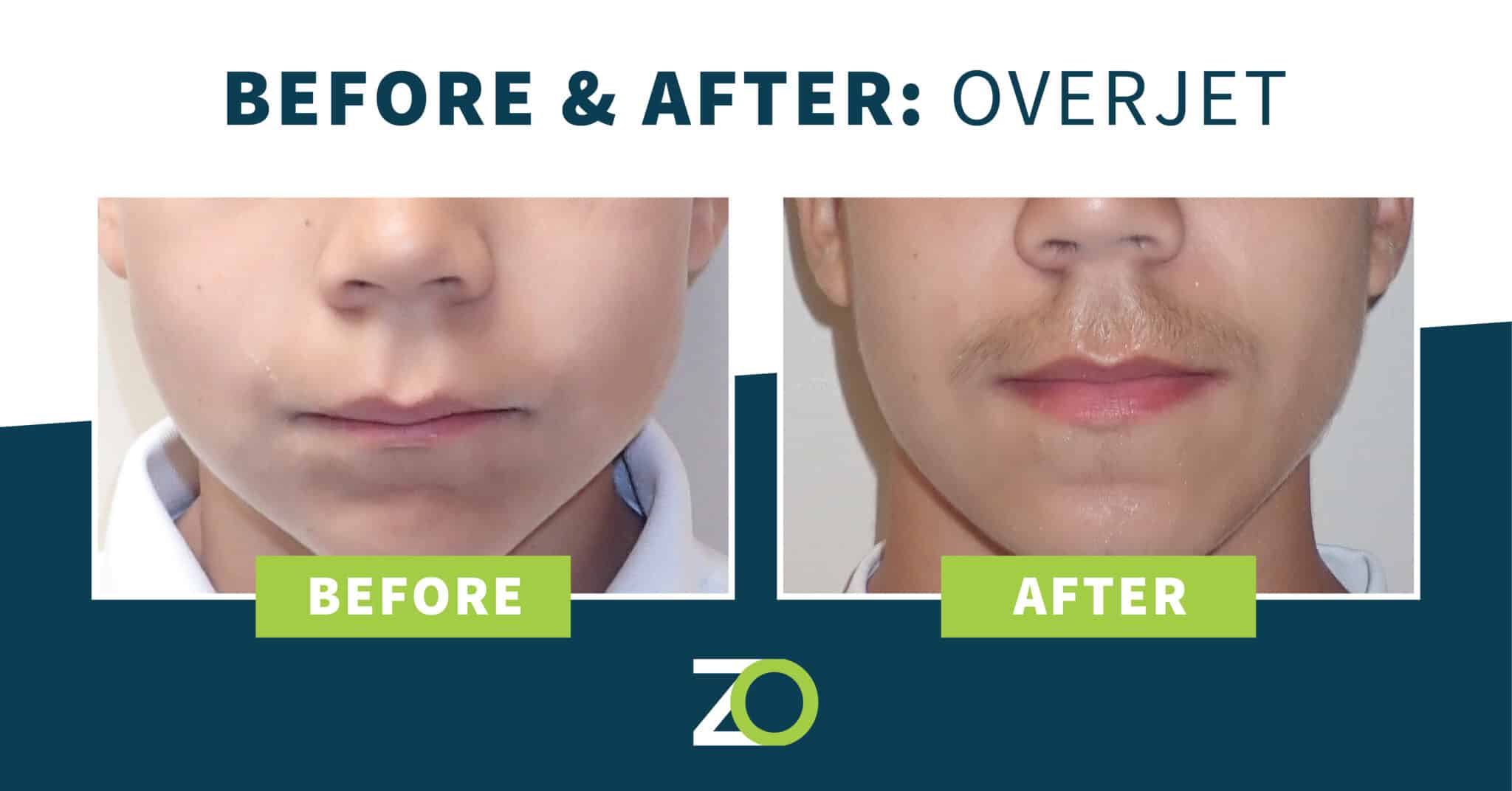 Do I Need Braces? Find Out Today!