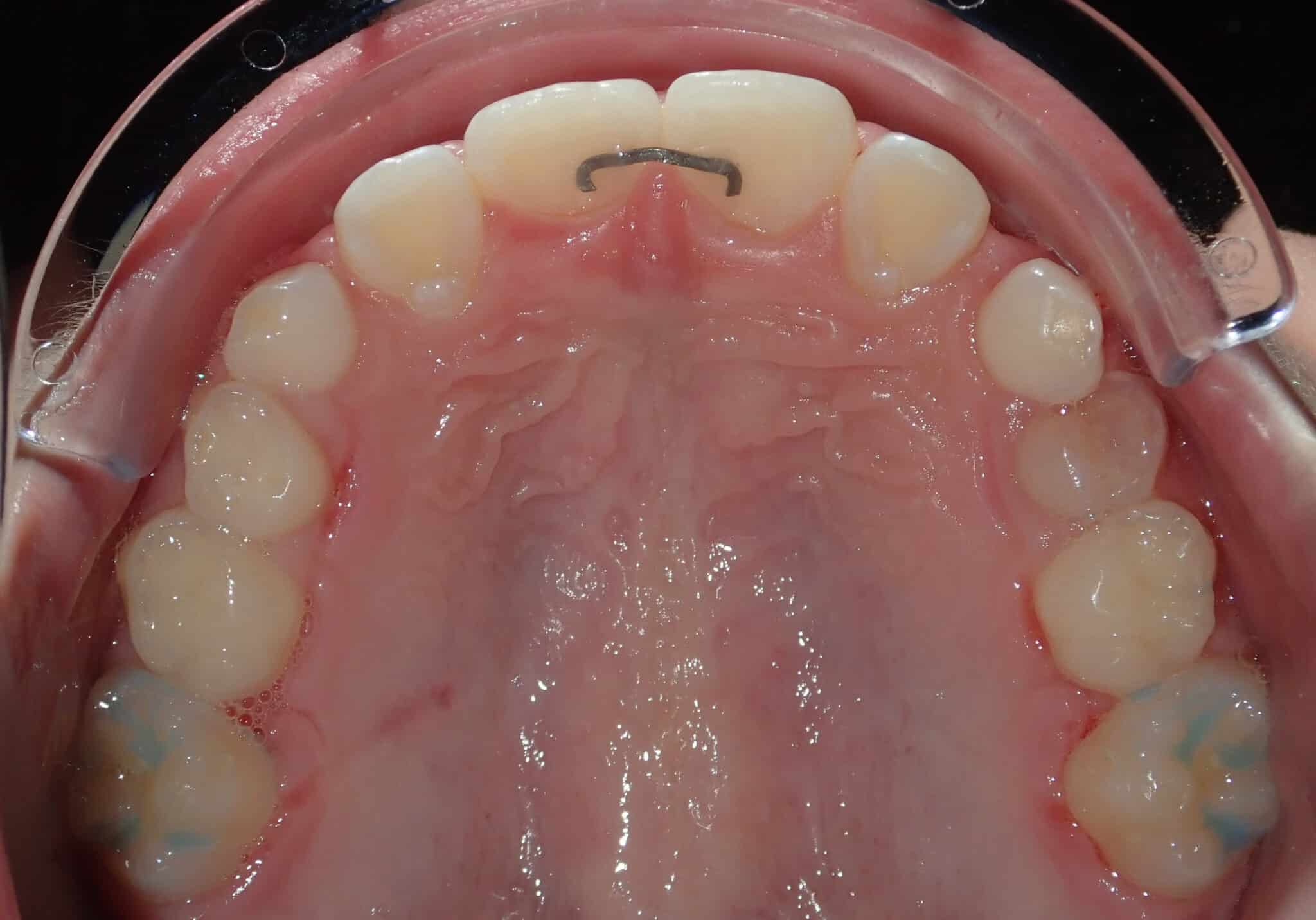 Palate Expanders for Adults & Kids: How They Help a Smile